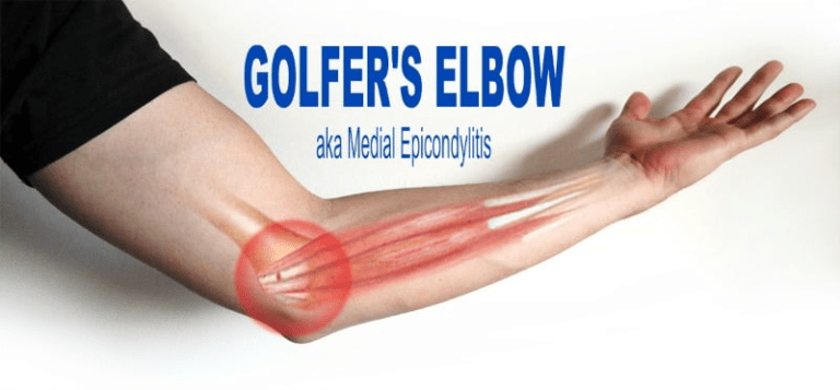 How to Tackle Golfer’s Elbow: Prevention, Treatment, and Recovery ...